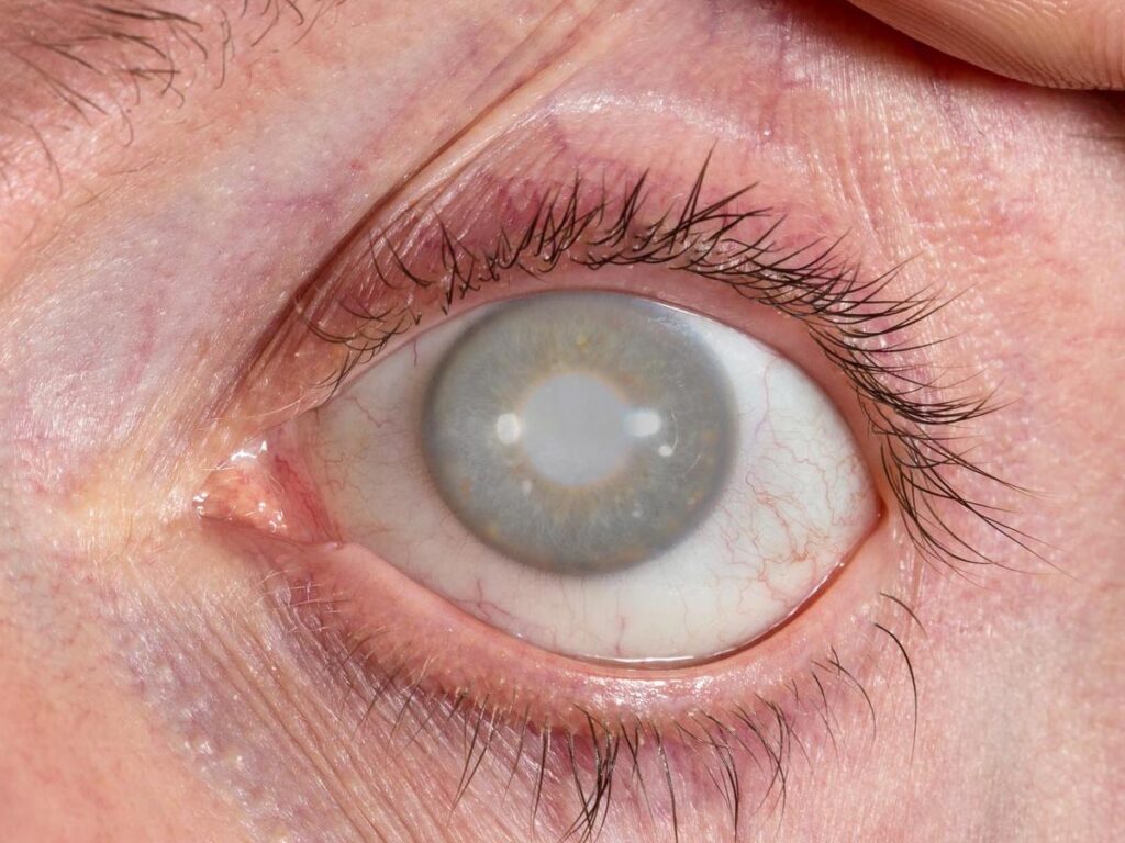 KATARAKTA ALI SIVA MRENA - Happymed